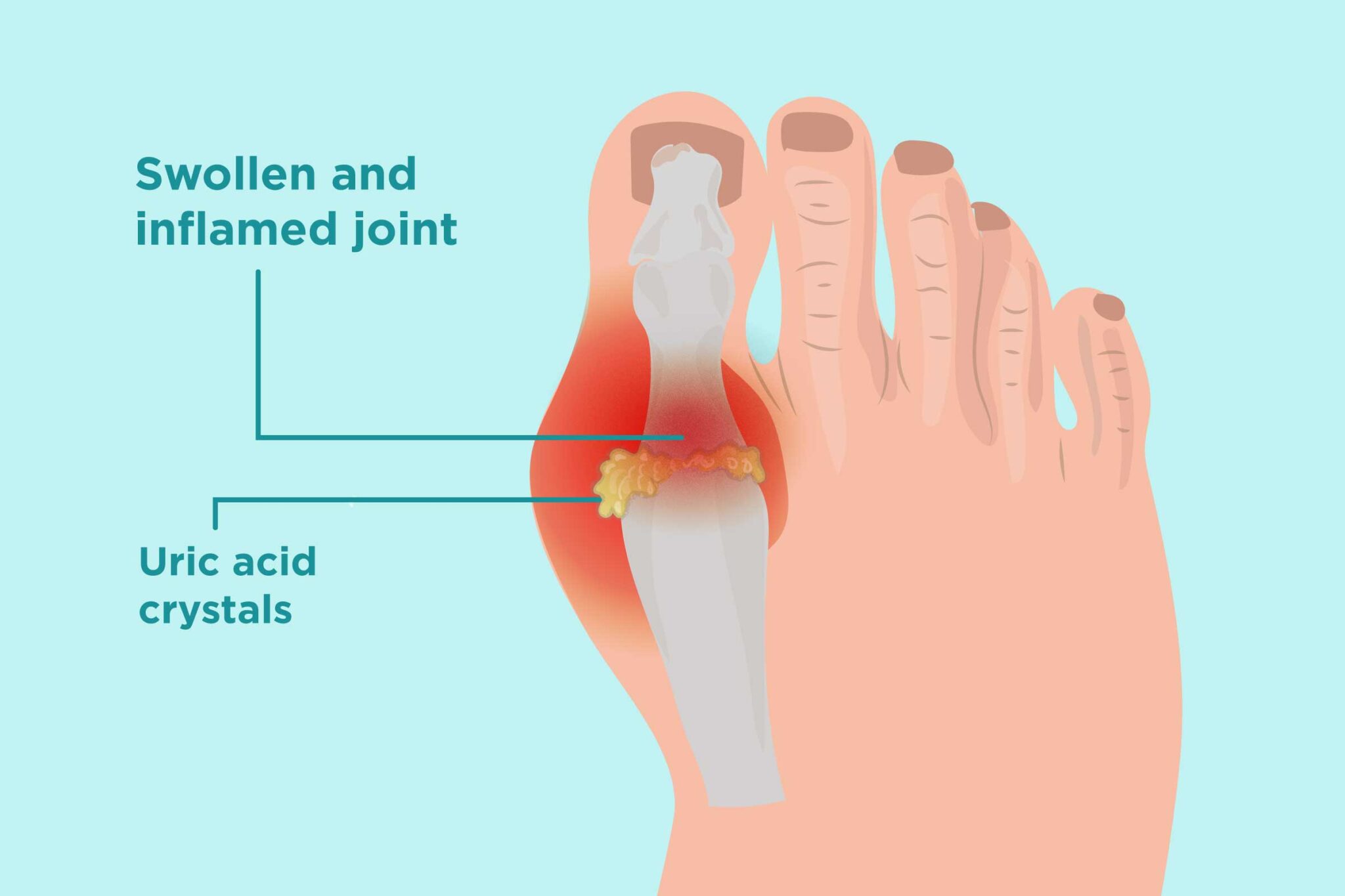 What Is Uric Acid? Causes, Symptoms & Prevention - Healthcare Blogs